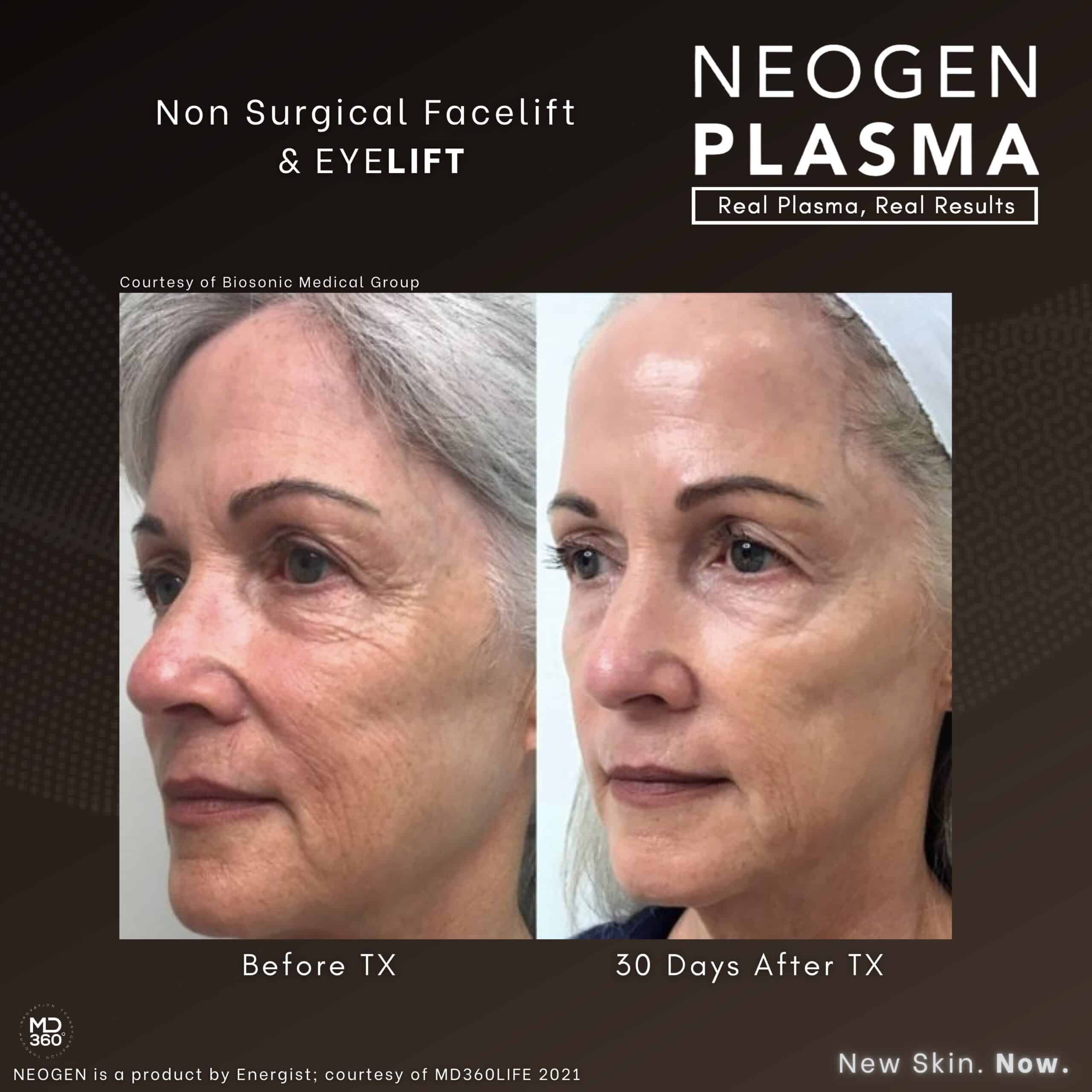 NeoGen Plasma - O'Brien Medical Evolution