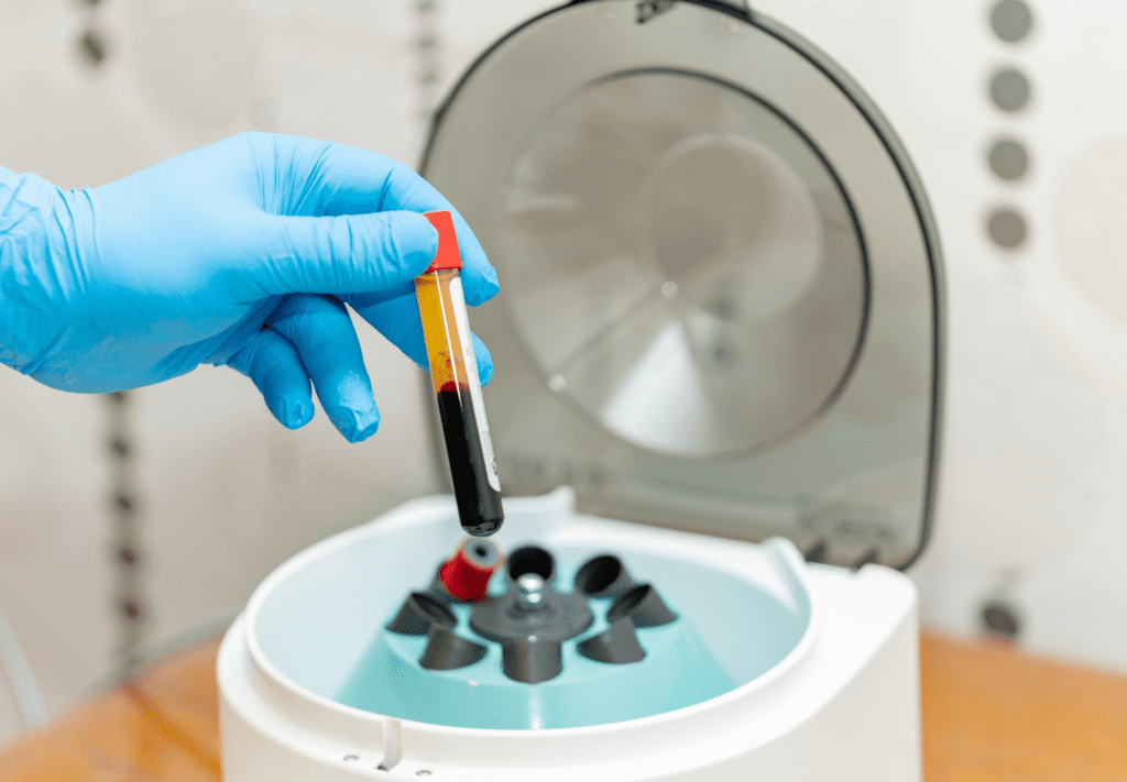 Platelet-rich plasma (PRP) - O'Brien Medical Evolution